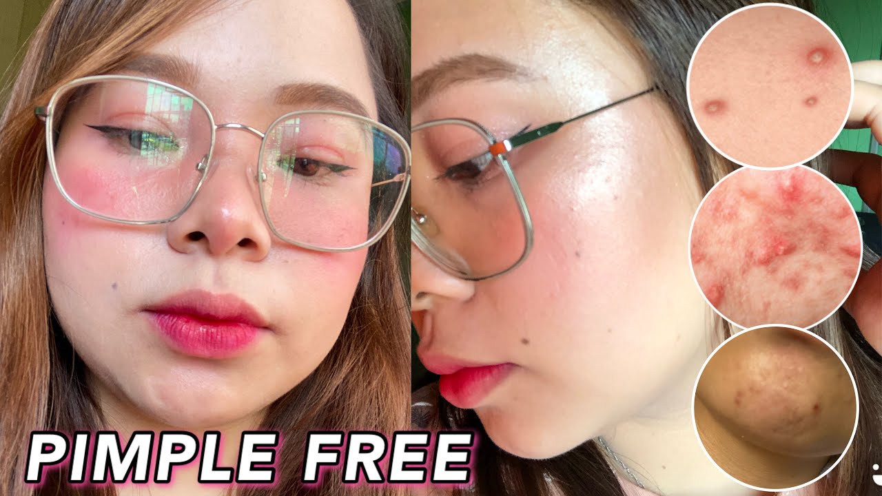 PAANO NAWALA ANG PIMPLES KO IN JUST 3 DAYS? (using 3 products only ...