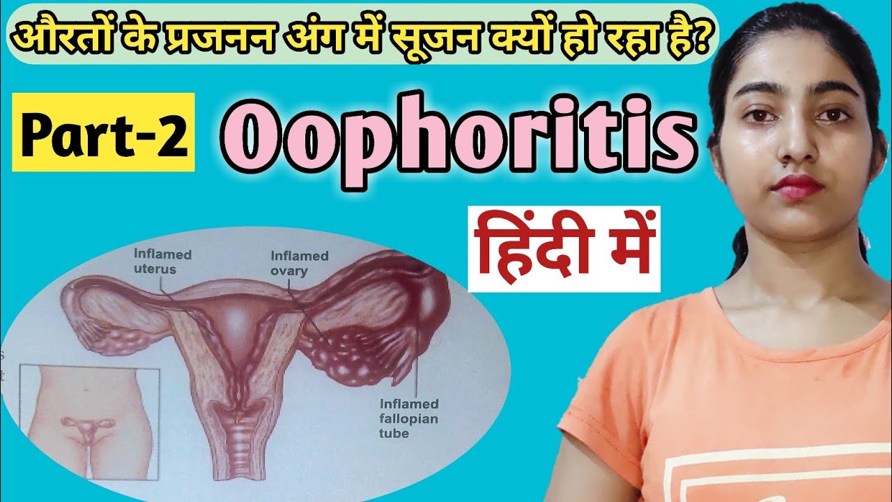 Oophoritis symptoms|Diagnostic evaluations or diagnosis|Treatment ...