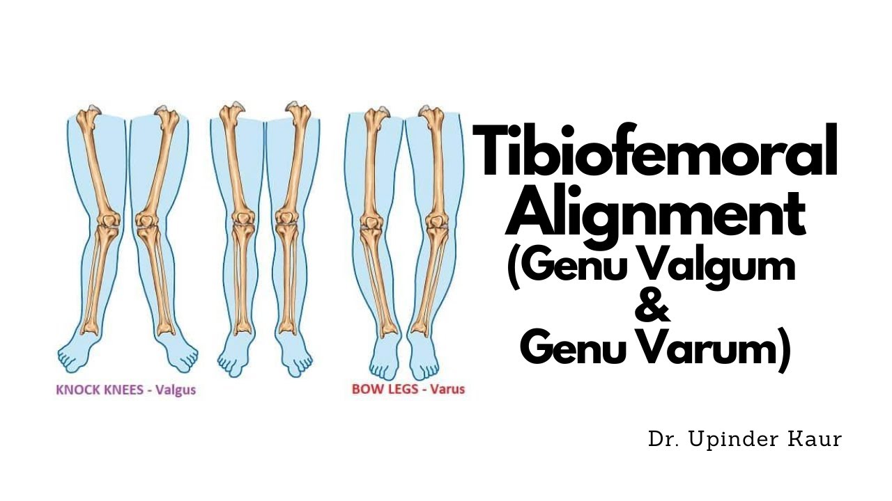 Tibiofemoral Alignment | Genu valgum | Genu varum - YouTube