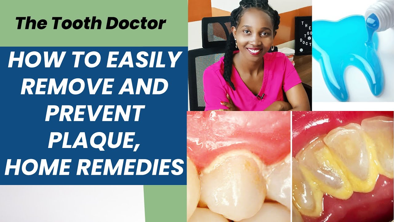 HOW TO EASILY REMOVE AND PREVENT PLAQUE, HOME REMEDIES #dentist #tartar ...
