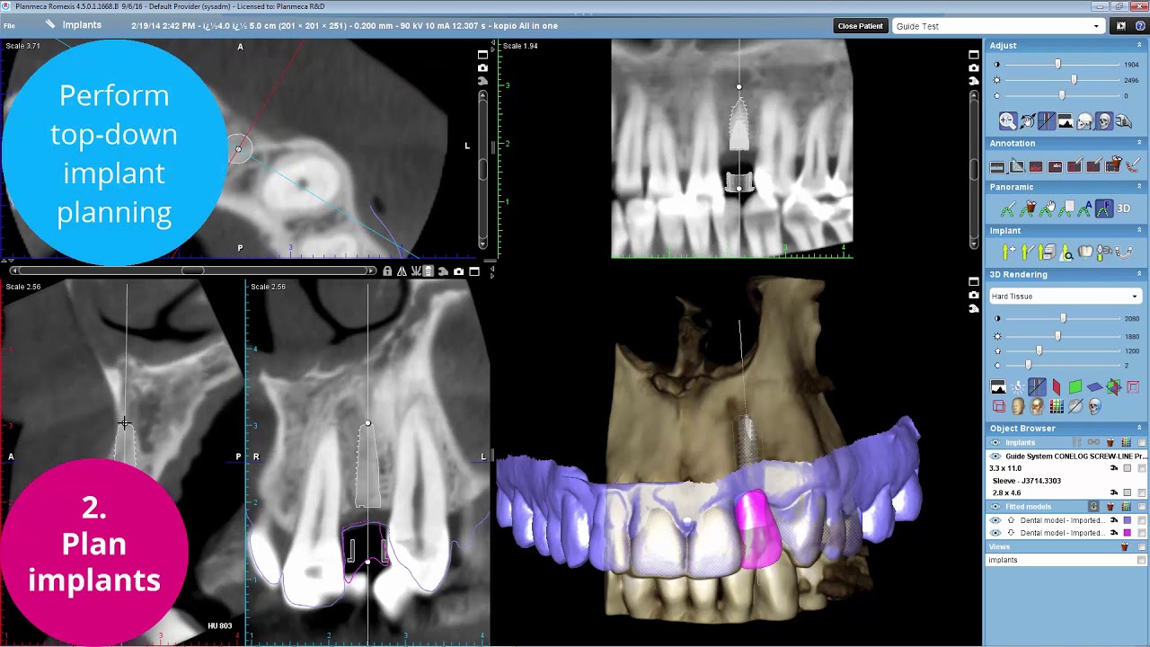 Planmeca Romexis — The Complete Implant Workflow - YouTube