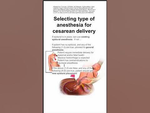 Selecting type of anesthesia for cesarean delivery - YouTube