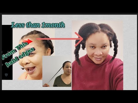 Magical Treatment To Regrow Bald scalp, Thin Edges and Unstoppable hair ...
