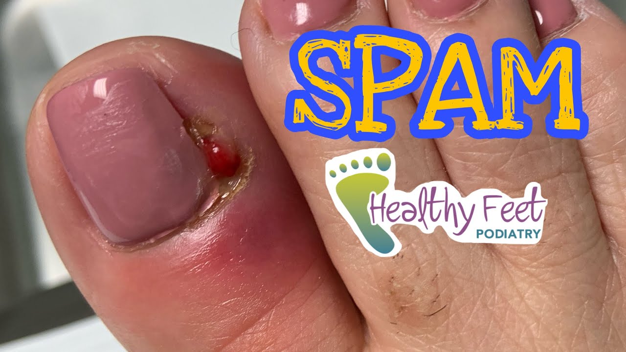 TOE SPAM!!! Kinda Angry Toe Nail - YouTube