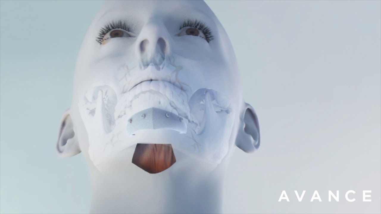 Facial Implants Dr. Erez Dayan Avance Plastic Surgery - YouTube