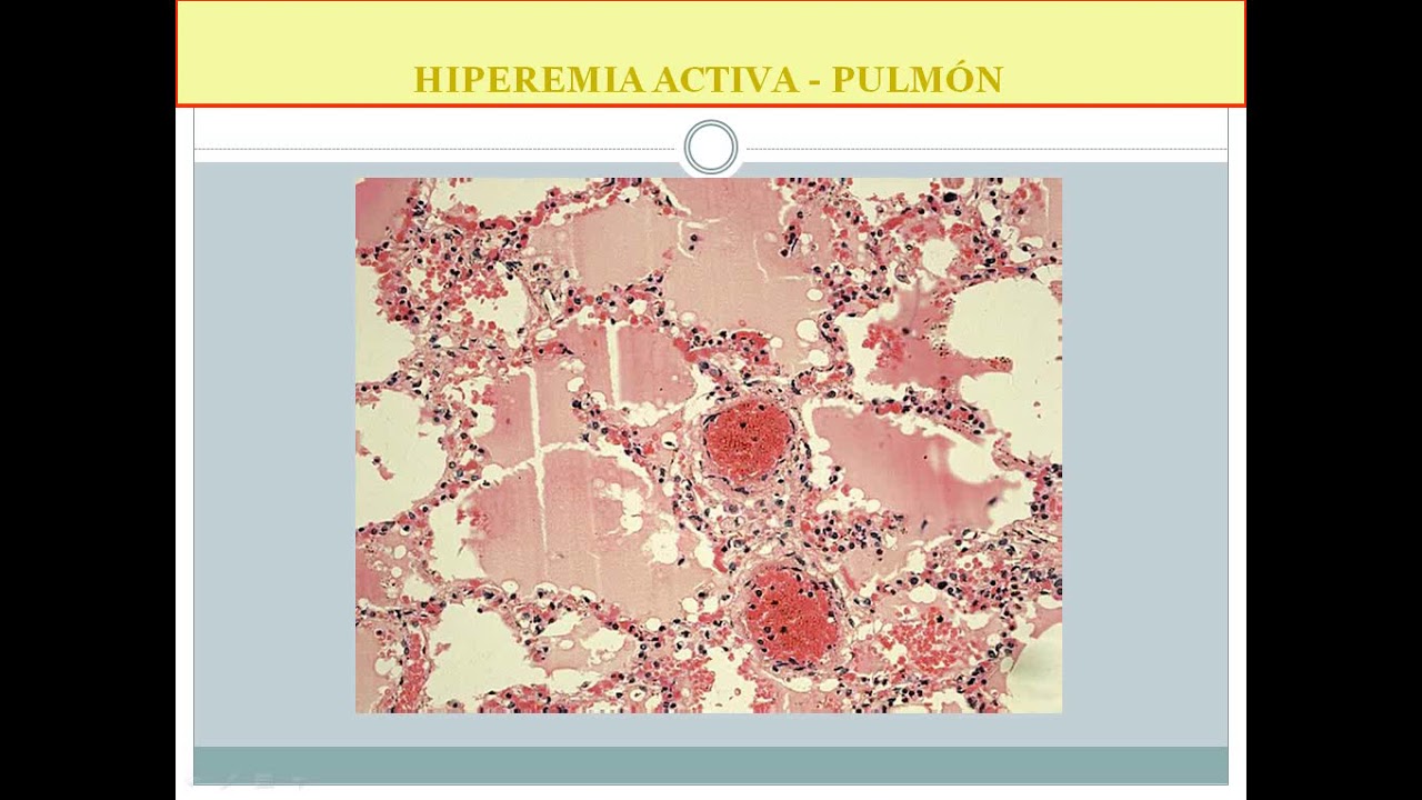 HIPEREMIA - YouTube
