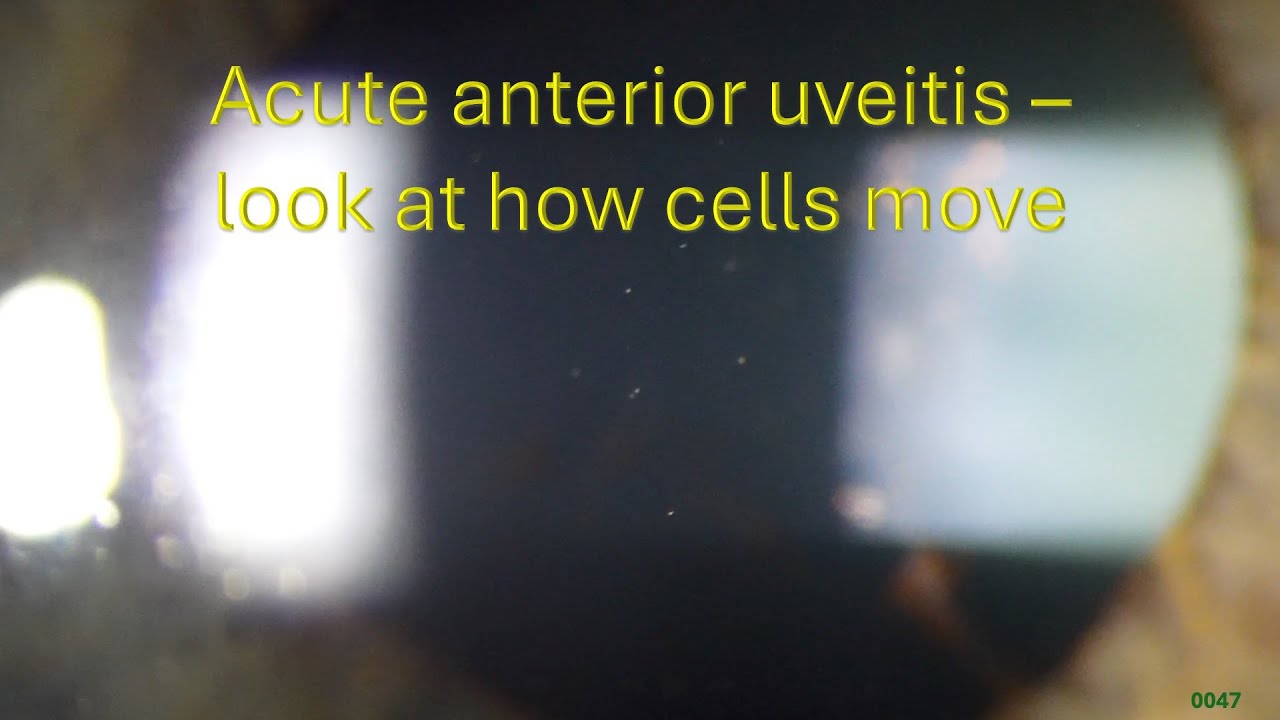 0046: Acute anterior uveitis - look at how the cells move! - YouTube