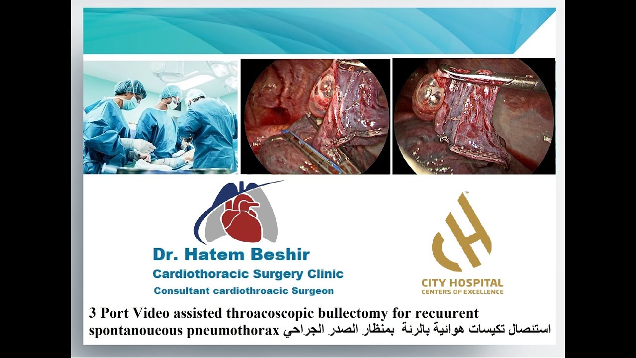 VATS bullectomy 3 ports - YouTube
