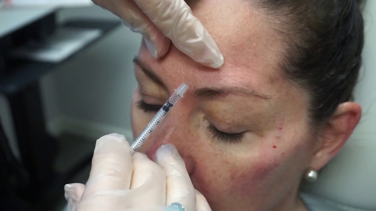 First Dysport Injection Experience - YouTube