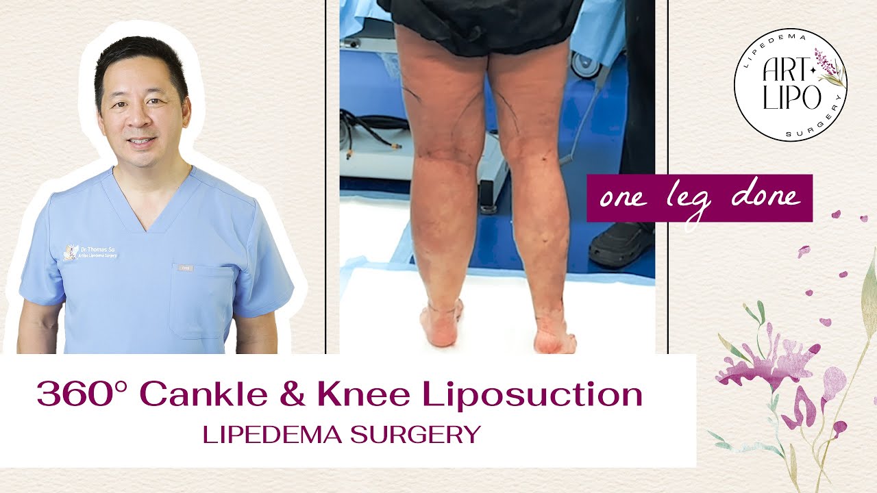 Barbie Doll Legs | Lipedema Liposuction | ArtLipo | Expert Dr. Thomas ...