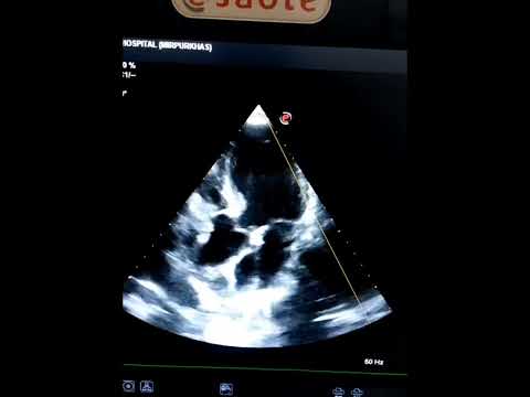echo cases / assess RWMA - YouTube