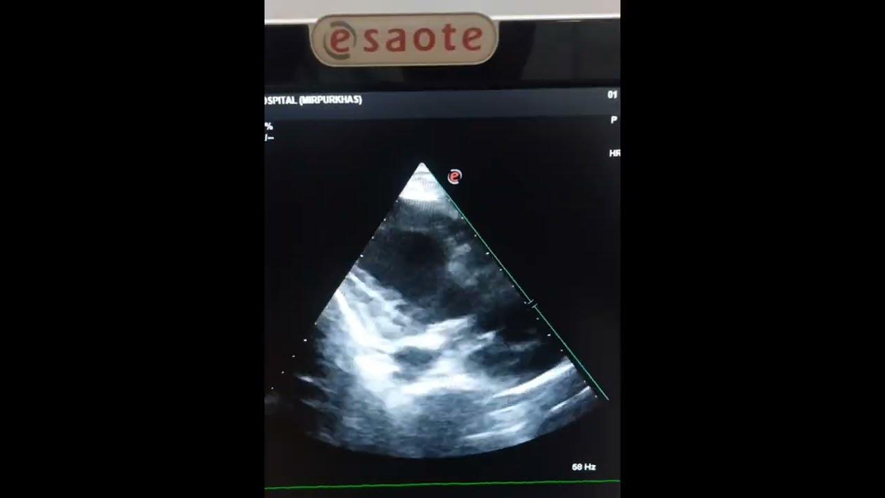 echo cases / assess RWMA - YouTube