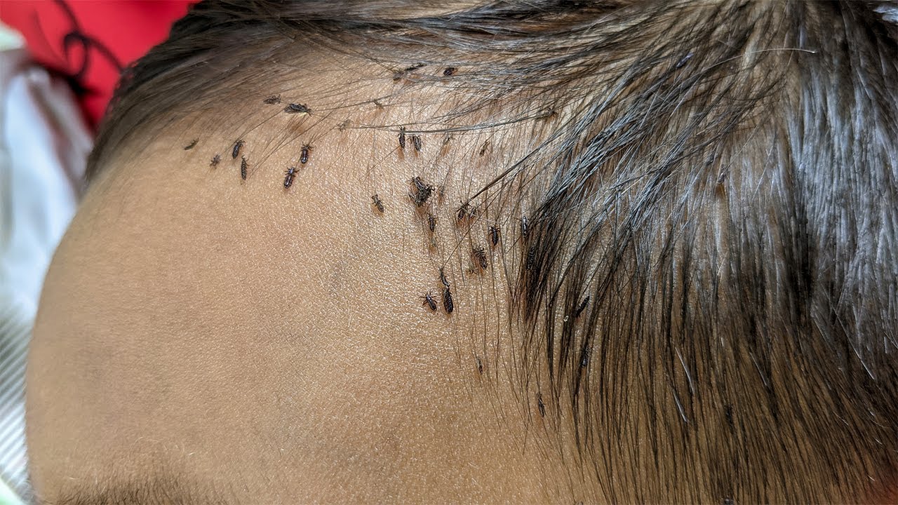 Wow there are a lot lice on short hair - Remove hundred lice from his ...