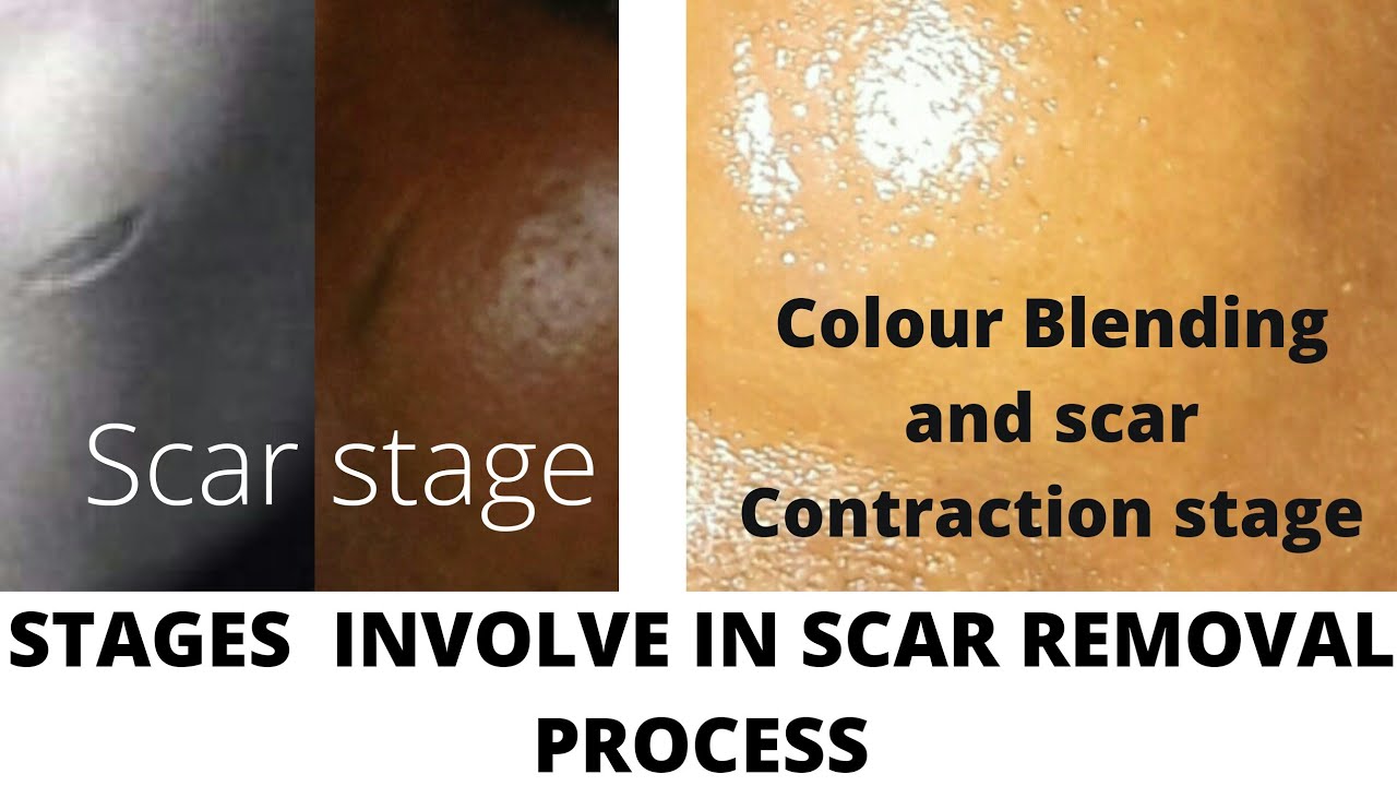 STAGES INVOLVED IN SCAR OR TRIBAL MARK REMOVAL PROCESS - YouTube