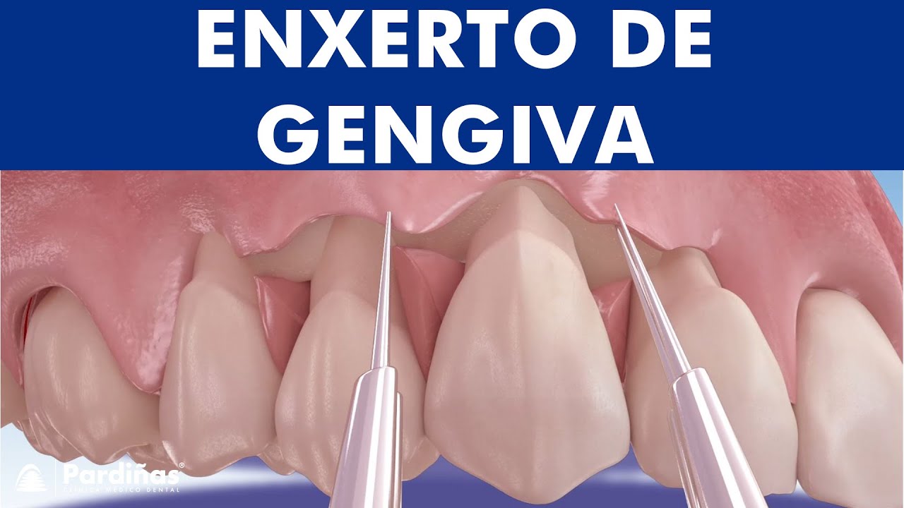 Tratamento da recessão de gengivas - Retalho deslocado coronalmente ...