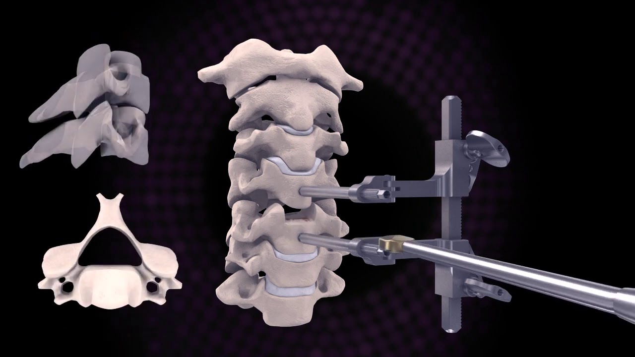 CP-ESP Surgical Technique 3D Video - YouTube