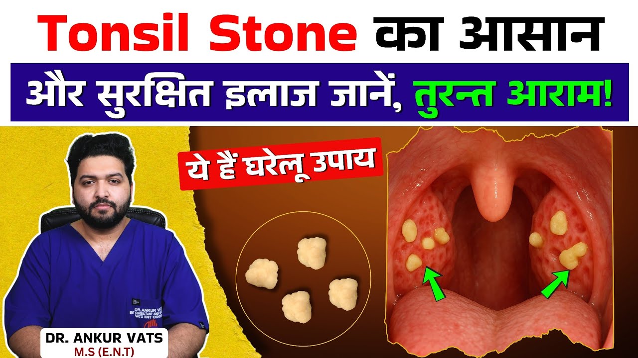 Tonsil Stone Treatment at Home | Tonsil Stone Removal Tips in Hindi ...
