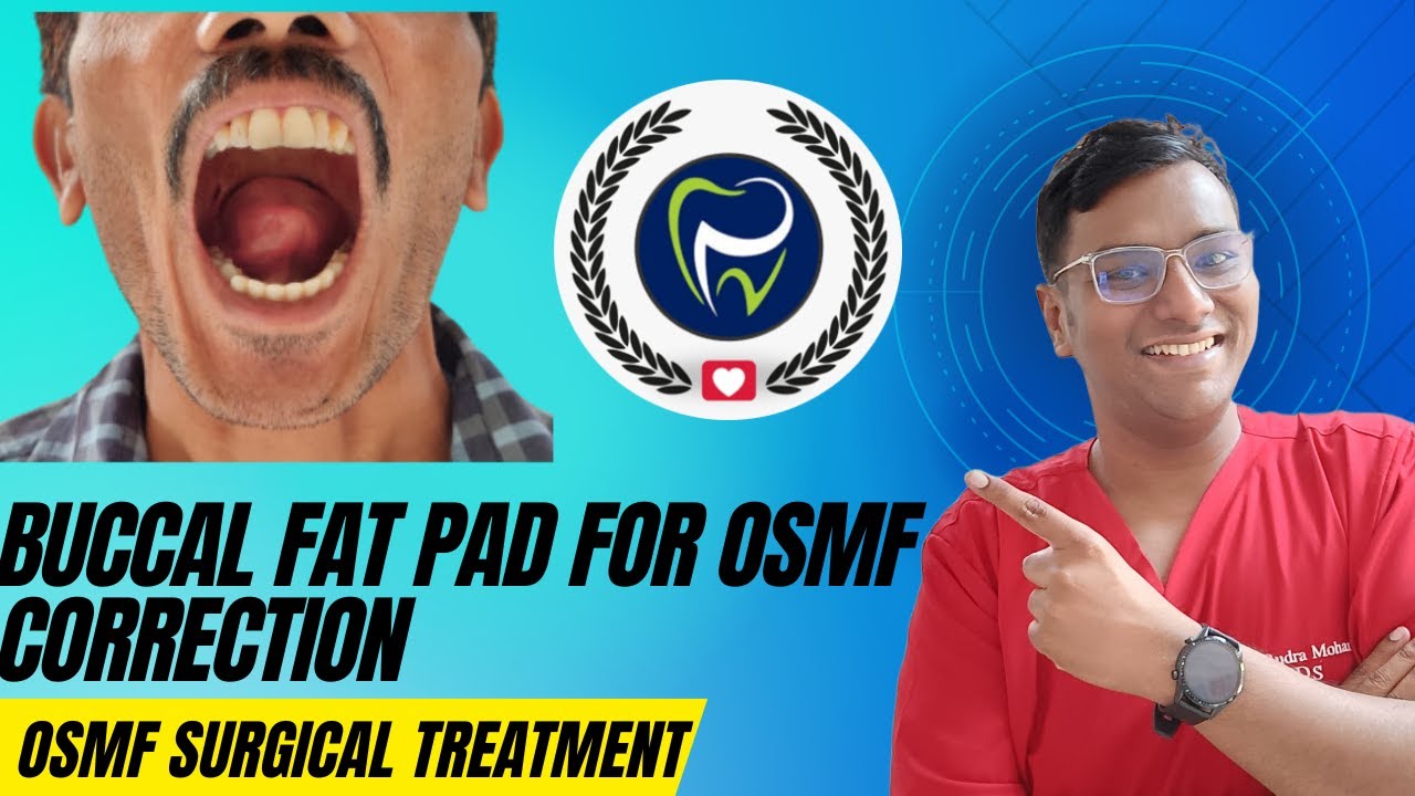 Dr Rudra Mohan | Buccal Fat Pad in Treating Oral Submucous Fibrosis: A ...