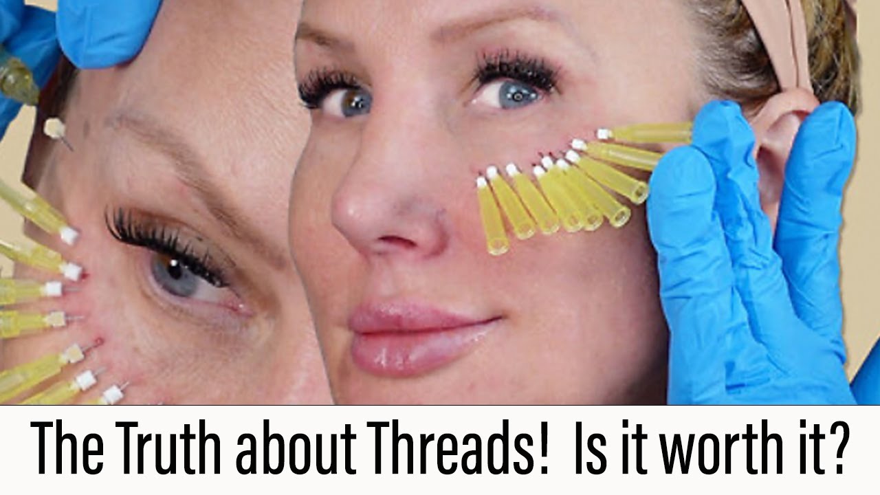 The Truth about Thread Lifts! Is It Worth It? - YouTube