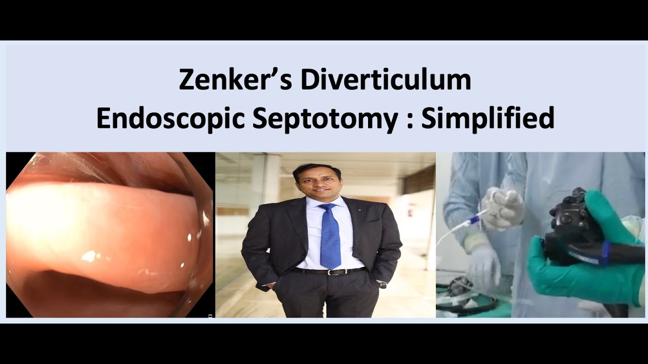 Zenker Diverticulum, treatment by endoscopic septotomy : Dr Vikas ...