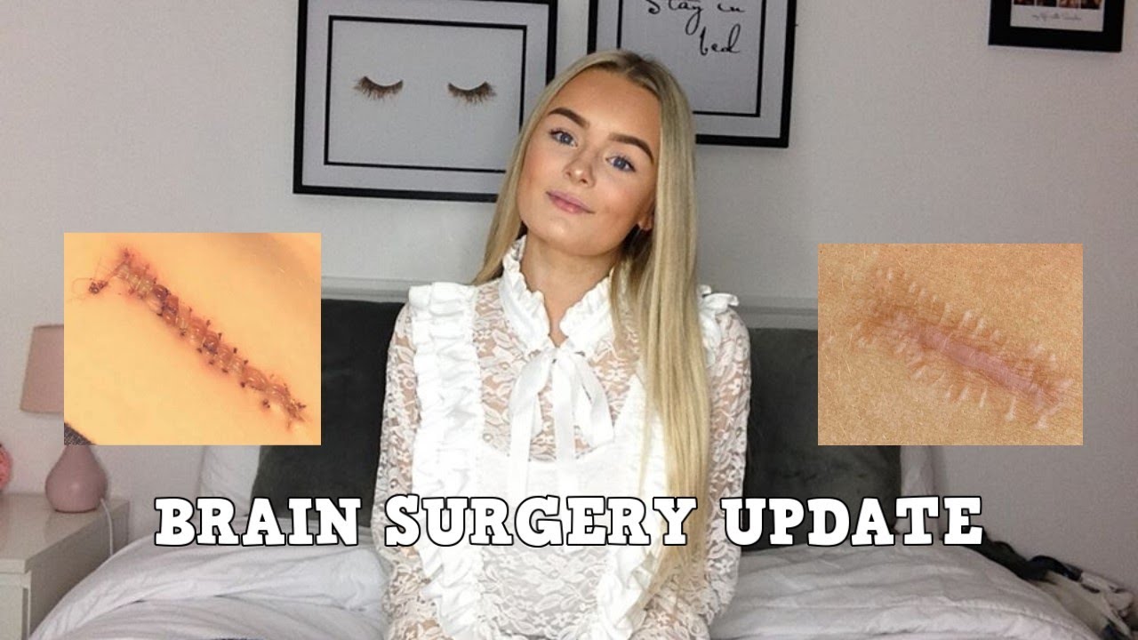 BRAIN SURGERY UPDATE - YouTube