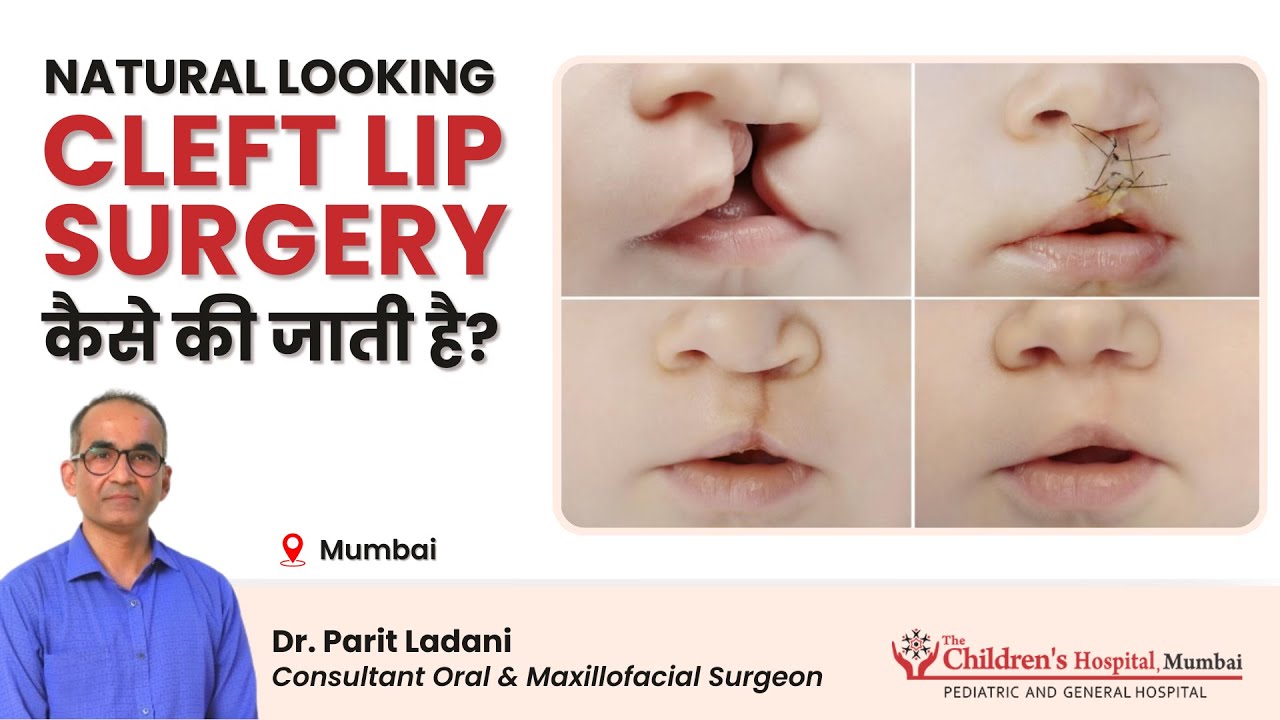 Cleft Lip and Palate Surgery which looks Natural by Dr. Parit Ladani ...