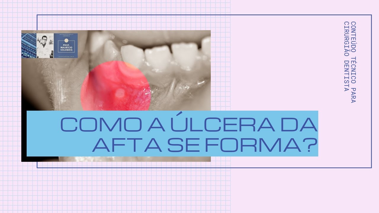 Como A lcera Da Afta Se Forma A Explica o T cnica Ao Cirurgi o como-a-lcera-da-afta-se-forma-a-explica-o-t-cnica-ao-cirurgi-o
