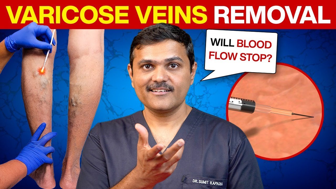 Can Removing VARICOSE VEINS Really Improve Your Health? - YouTube
