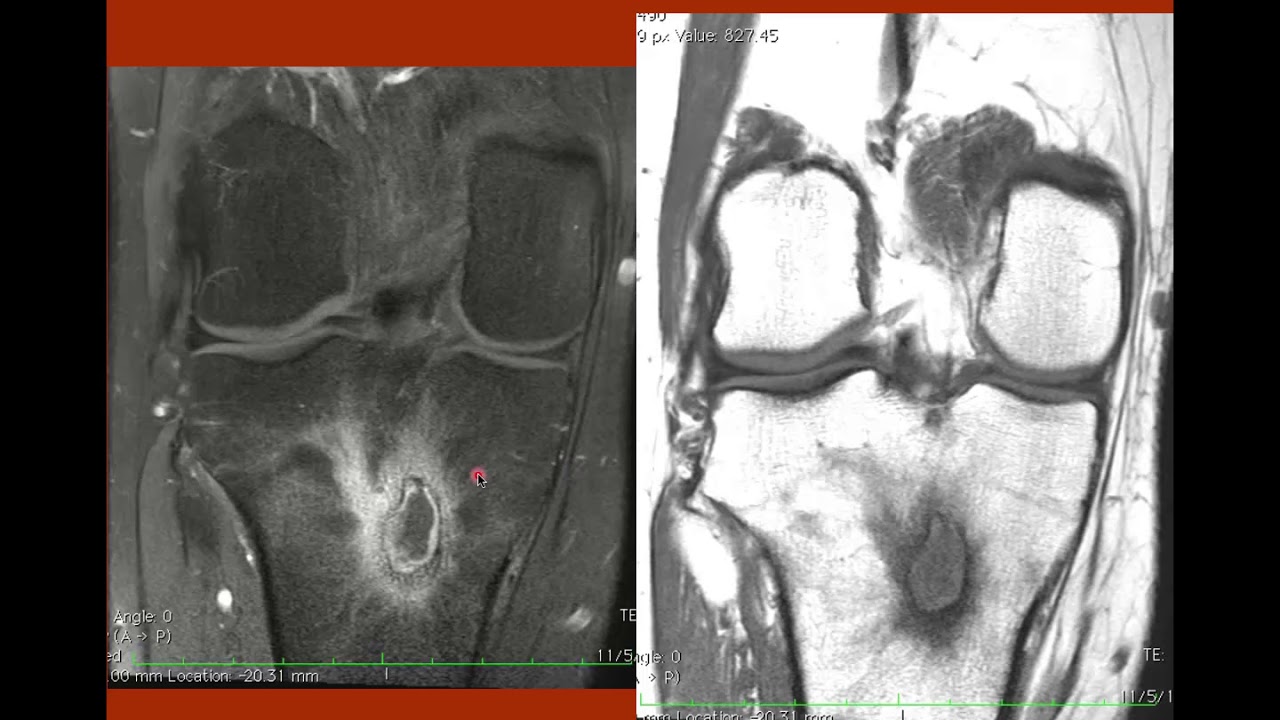 Brodie's Abscess - YouTube