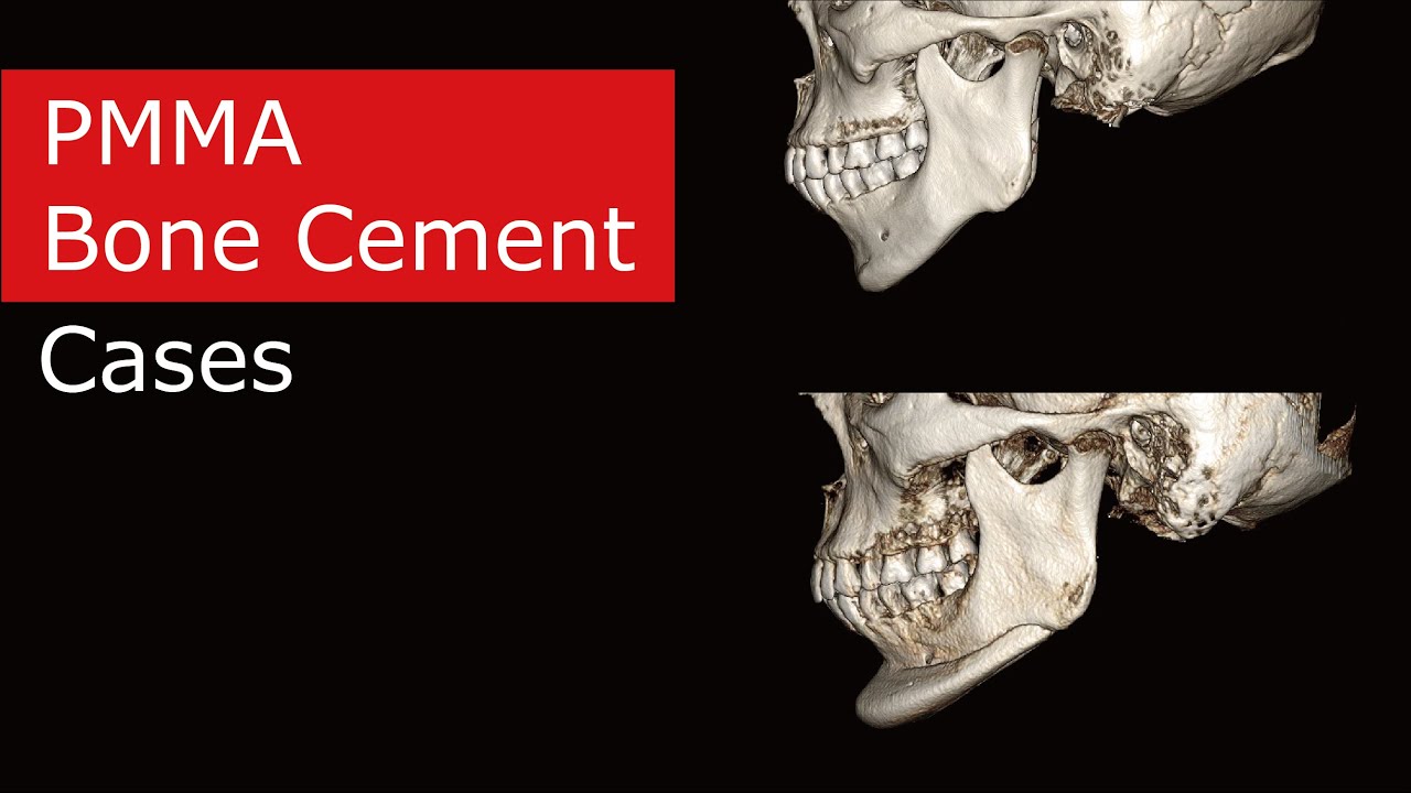 Plastic Surgery Cases Using PMMA Bone Cement - YouTube