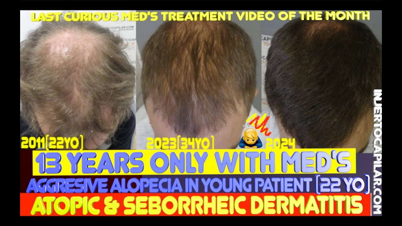 13 years only with med’s.Aggressive alopecia in young patient (22yo) w ...