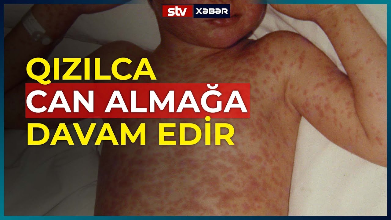 ŞƏMKİRDƏ 4 YAŞLI UŞAQ QIZILCA QURBANI OLDU - YouTube