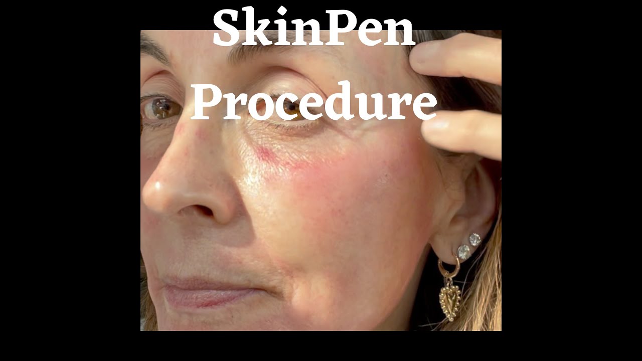 My SkinPen Experience | Skin Rejuvenation | Faces Over 60 - YouTube