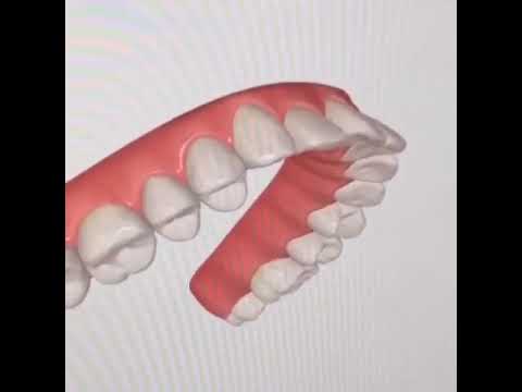 Invisalign Go Simulation case1 - YouTube