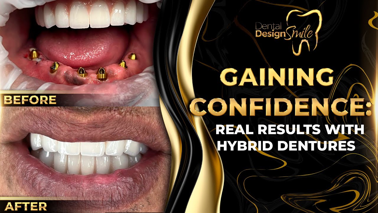 Gaining Confidence: Real Results with Hybrid Dentures - YouTube