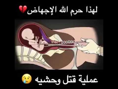 Abortun əsl üzü. Öz uşağlarınızı doğramayın.