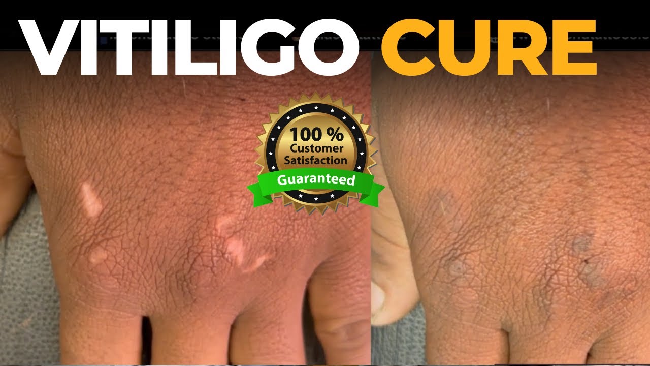 100% Success rate | Vitiligo skin treatment | No side effects | Machu ...