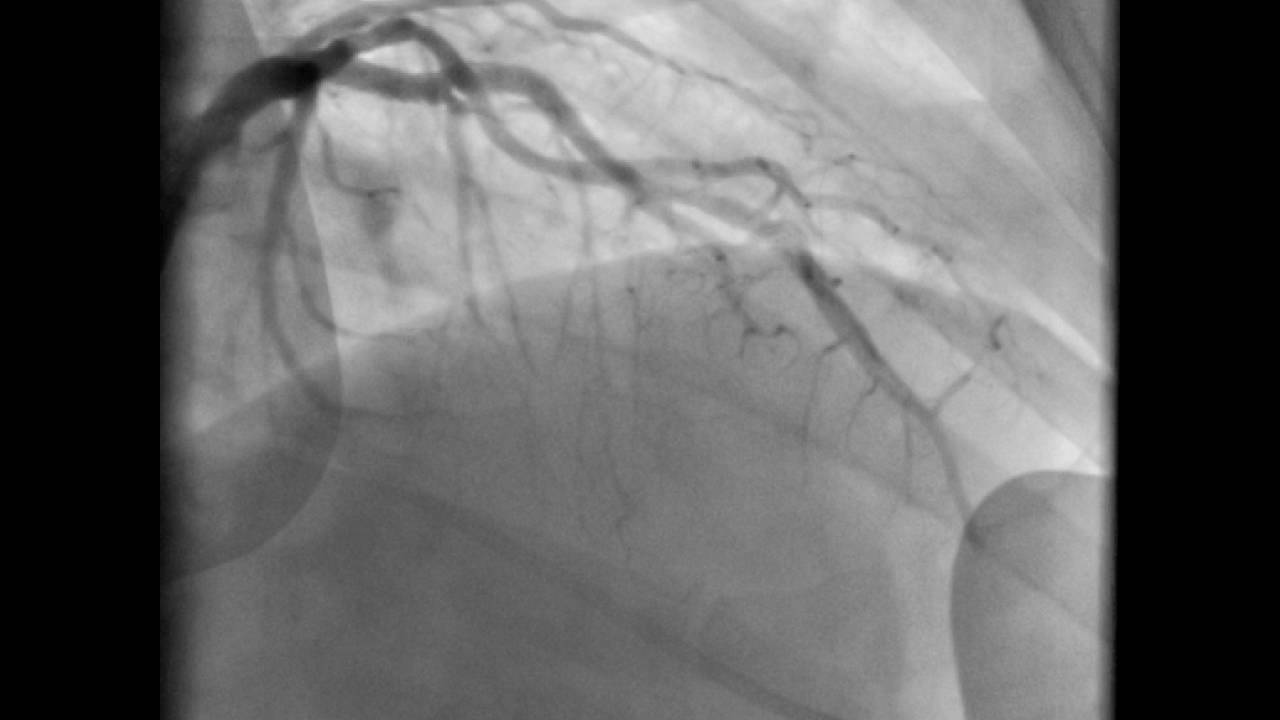 corornary artery perforation - YouTube
