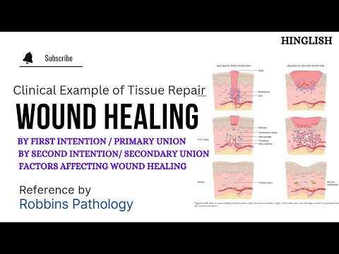 wound Healing | Clinical Example of Tissue Repair | Healing by First & Second Intention | KTC ...