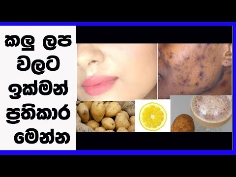 මුහුණේ ඇති කළු ලප වලට ඉක්මන් ප්‍රතිකාර මෙන්න - Remove DARK SPOTS Permanently