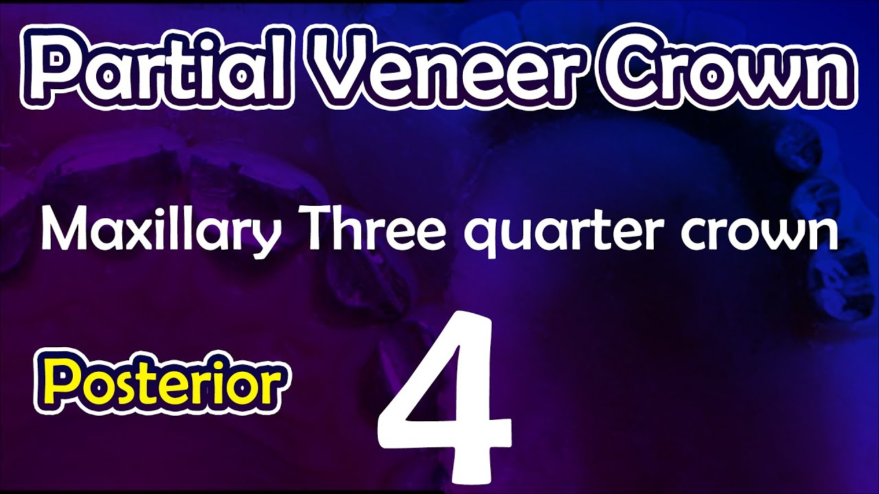 crown|partial veneer crown (three quarter crown for posterior teeth)4 ...