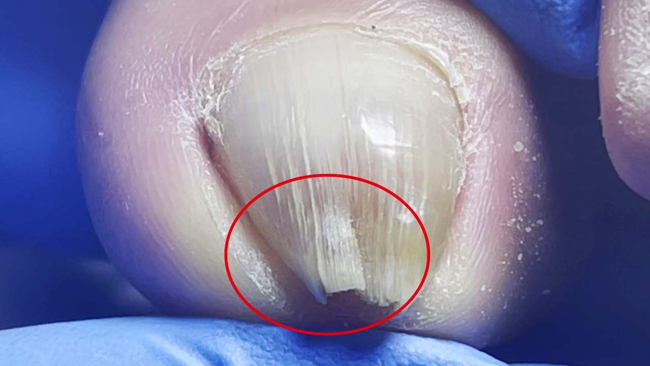 Pedicure Tutorial: Huge Ingrown Nail Quick Trim! - YouTube