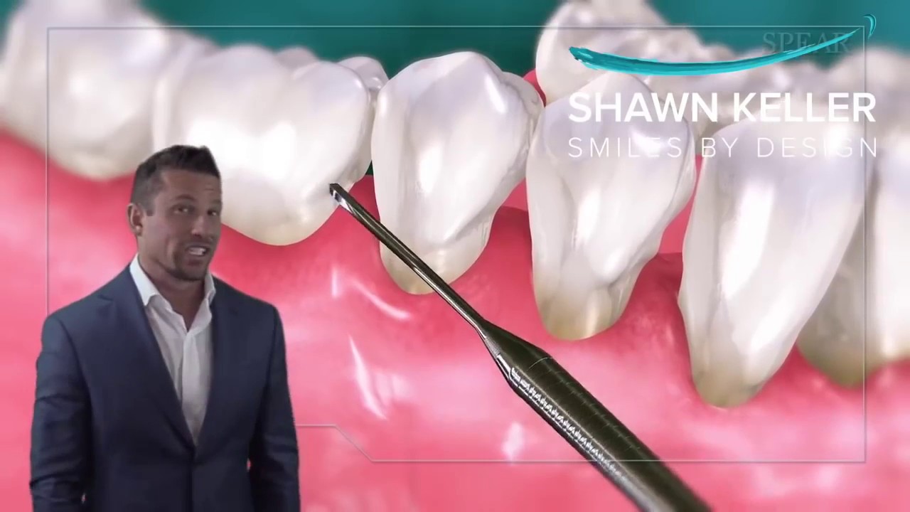 Bone Loss Around Your Teeth | The Real Cause Will Shock You | The Side ...