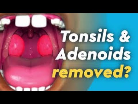Tonsillectomy - step by step - YouTube