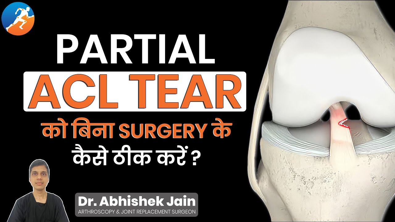 Partial ACL Tear का इलाज | Treatment of Partial ACL tear Without ...