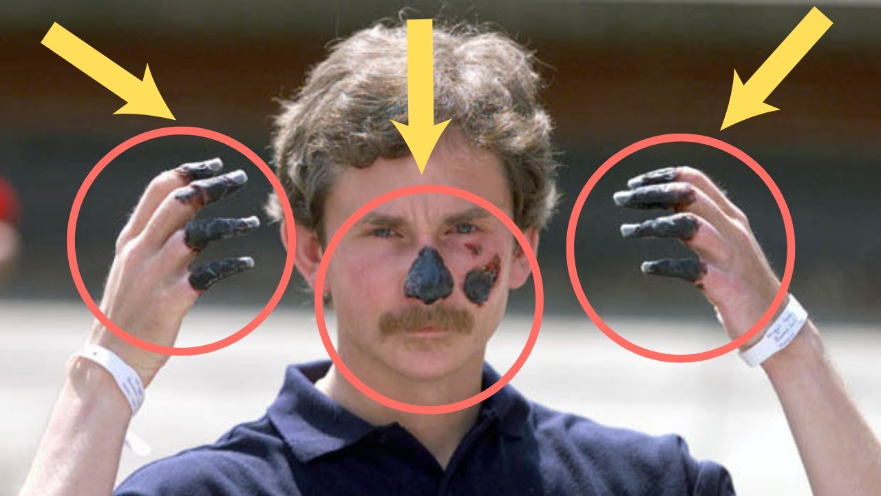 Frost Bite Symptoms - Frost Bite Fingers and Frostbitten Feet - Cold ...