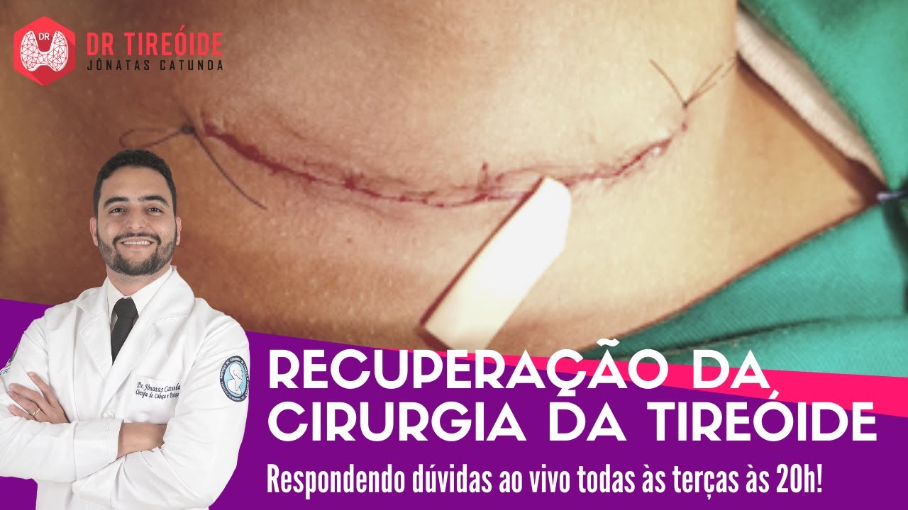 Recuperação da cirurgia da tireóide - Dr Tireóide responde #115# - YouTube
