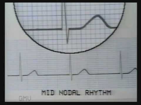 Nodal Rhythms ECG - YouTube