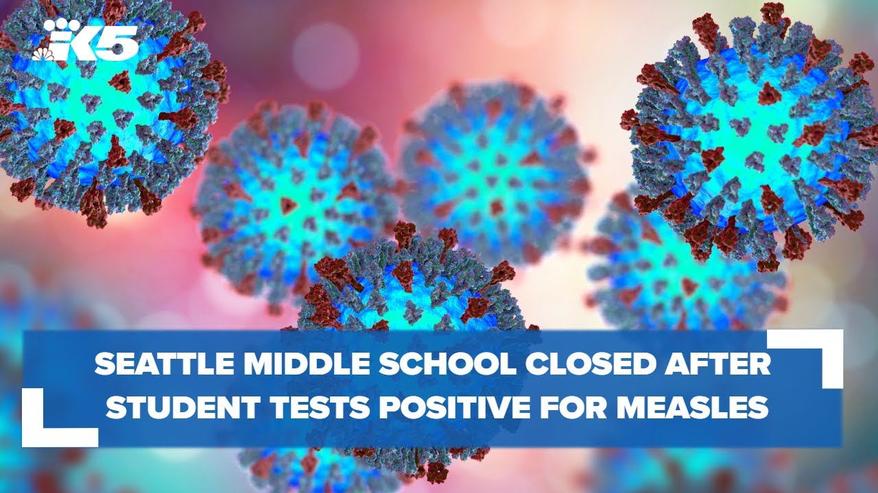 Seattle middle school closed after student tests positive for measles ...