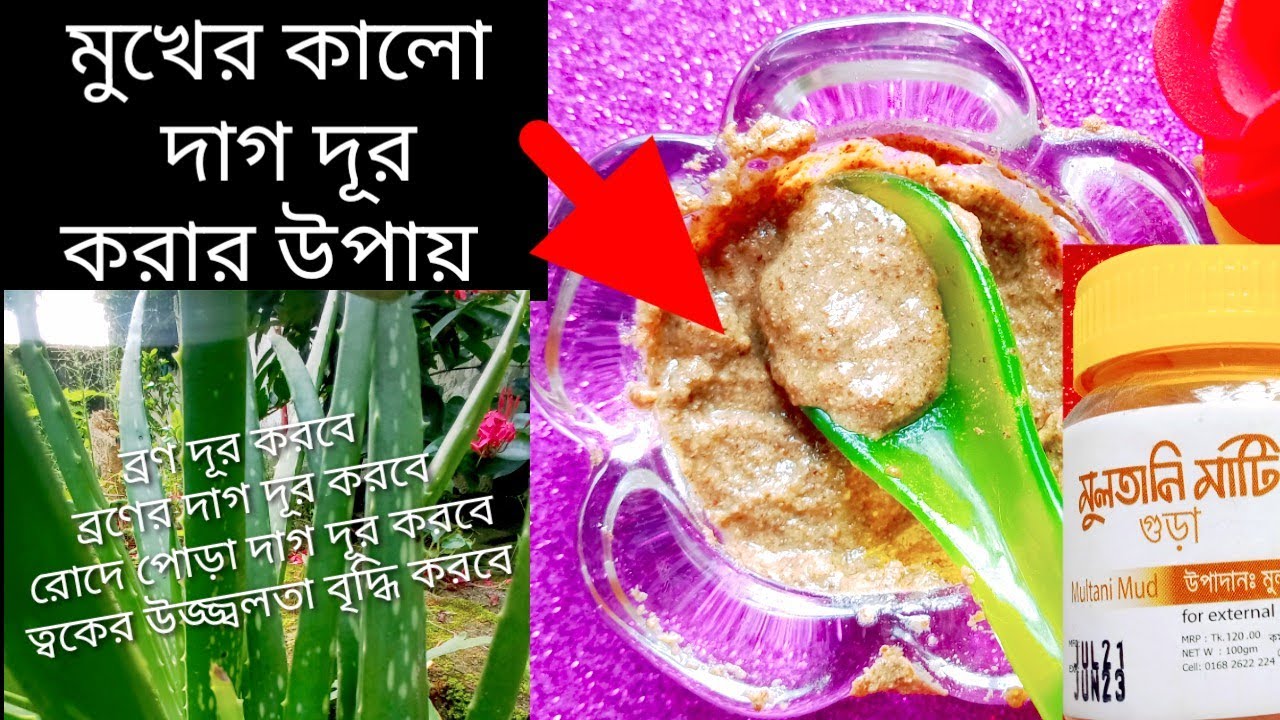 #Mukher kalo dag dur korar upay #মুলতানি মাটি ও অ্যালোভেরা ফেসপ্যাক # ...